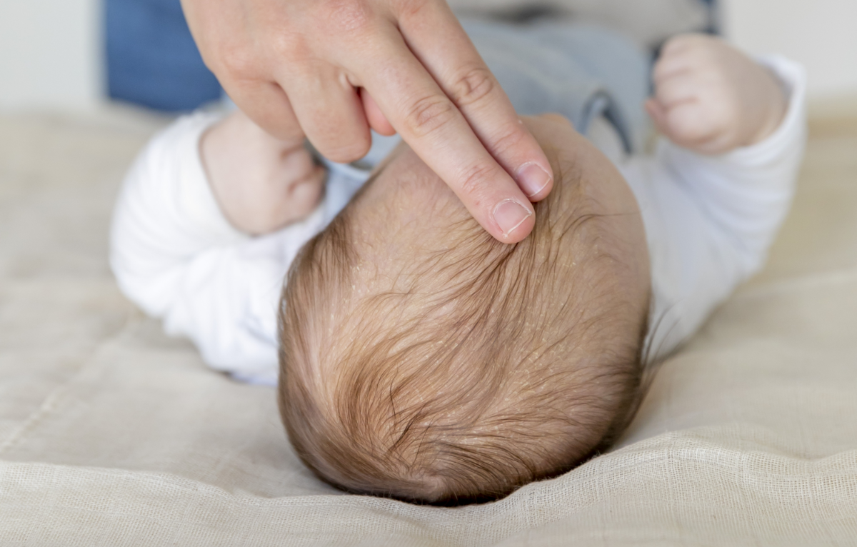 Kopfgneis oder Milchschorf? Der Unterschied! – das boep